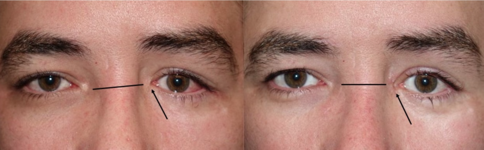 Eyelid or Orbital Trauma - Repairing the Medial Canthus